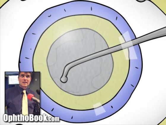 Cartoon Cataract Surgery (Video) - TimRoot.com