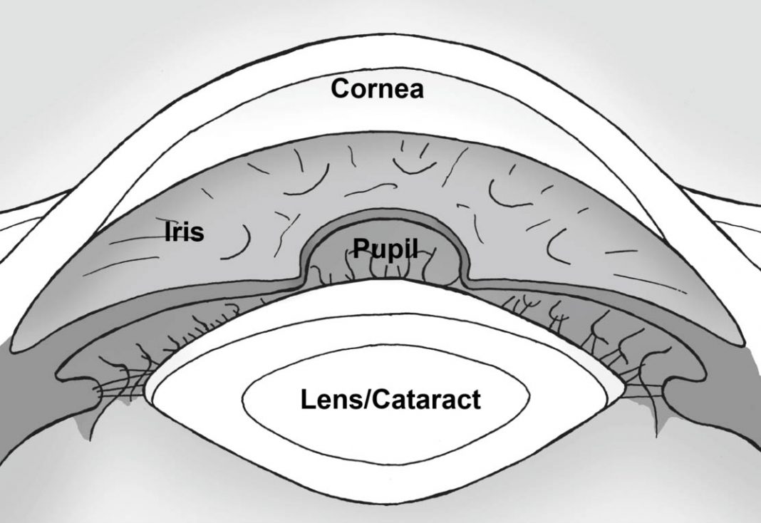 Chapter 1: Introduction to Cataracts - TimRoot.com