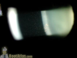 "Cell and flare" in the eye (Video) - TimRoot.com